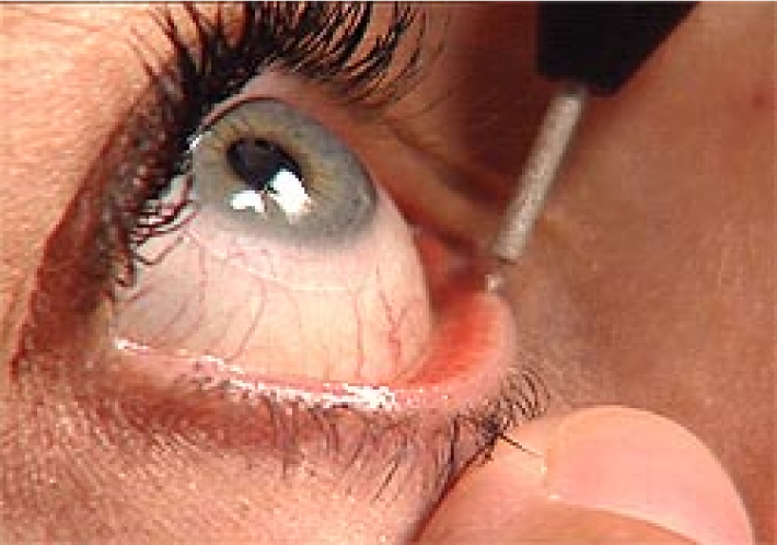 Dry Eye Syndrome: Lesson # 21 – Optical Training Institute