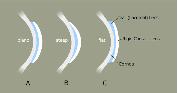 Top Contact Lenses for Astigmatism: A Comprehensive Review
