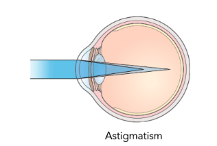 Anatomy & Refractive States of the Eye: Optical Infinity Deep Dive