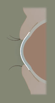 Soft Lens Fitting and Evaluation: Comprehensive Guide by experts