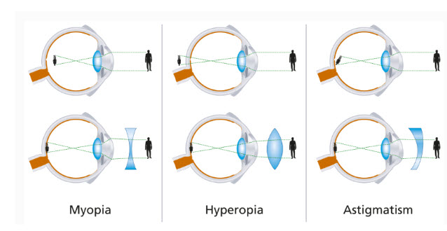 Anatomy & Refractive States. Identifying Ametropia with the Optical Cross