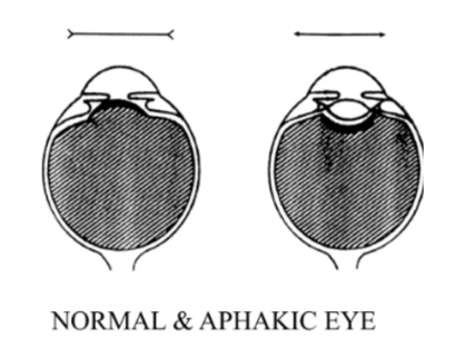 Advanced Techniques for Managing Aphakia