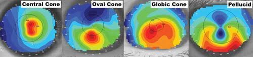 Armoring the Cone: Lesson # 4 – Optical Training Institute